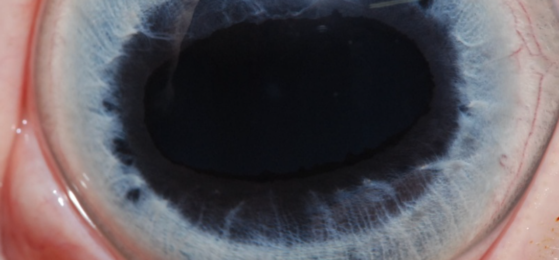 Connaître les maladies de la cornée